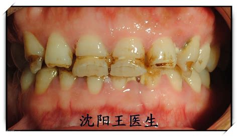 追美重度釉质发育不全铸瓷修复 王玉楼的博客 KQ88口腔博客