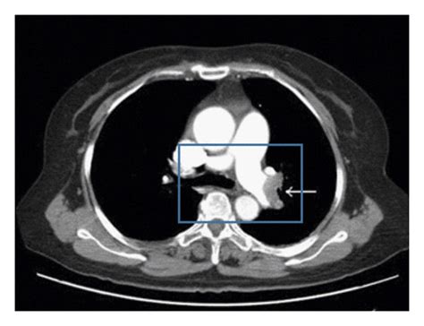 Ct Images A Multiple Filling Defects In The Right Pulmonary Artery Download Scientific