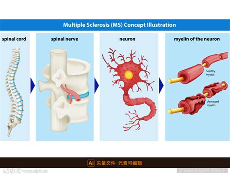 医学多发性硬化插画设计图 医疗保健 生活百科 设计图库 昵图网