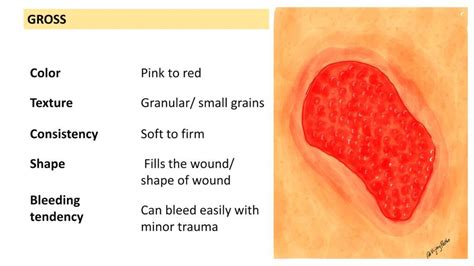Granulation Tissue Pathology Made Simple