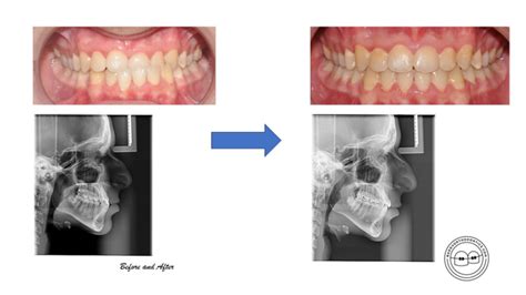 Incisor Classification Why Its Important Badov Orthodontics