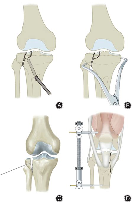 Tibial Plateau Fracture Orif