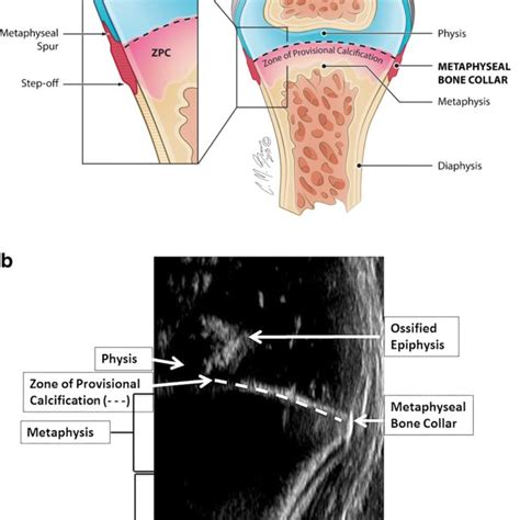 Anteroposterior And Lateral Radiographs Of A 5 Month Old Girl Download Scientific Diagram