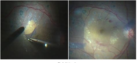 Figure 2 From Evaluation Of Planned Foveal Detachment Technique For