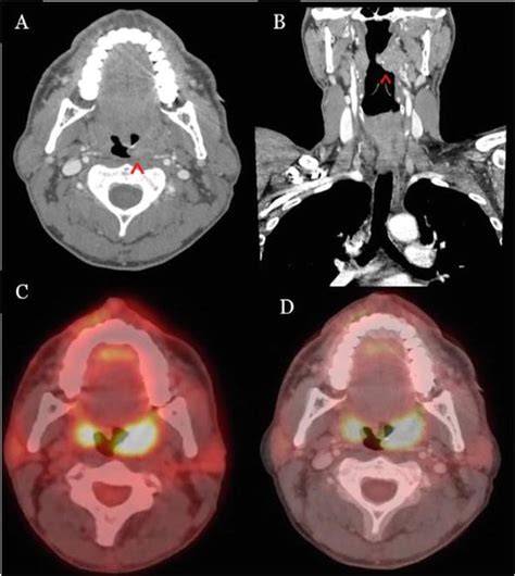 Lingual Tonsil Cancer Pictures