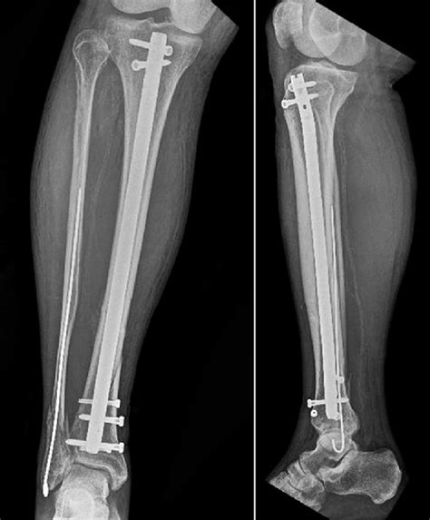 The Same Fracture Of Figure 1 After Surgery Imn And K Wire To The Same Fracture Of Figure 1 After Surgery Imn And K Wire To