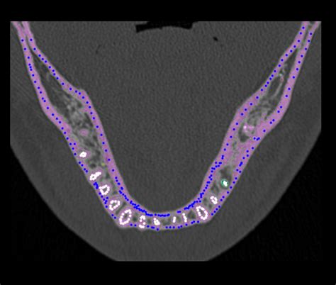 Result Of The Threshold Transform And Setting Markers Download