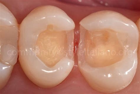 How High Should Be The Proximal Wall In Class Ii Restorations