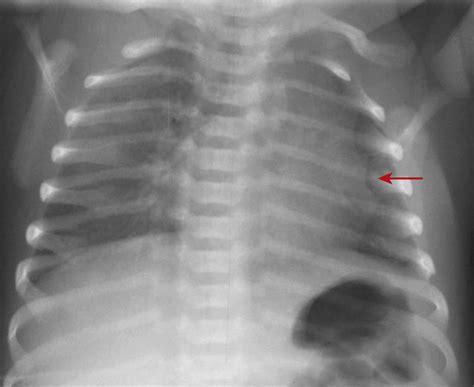 Mediastinal Masses Clinical Tree