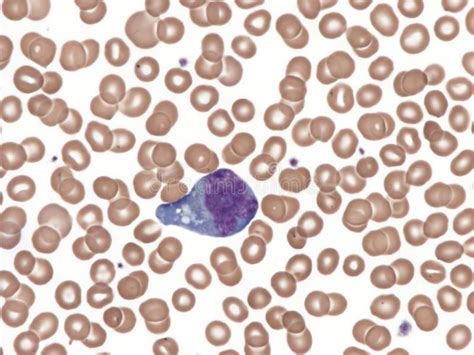 Diffuse Large B Cell Lymphoma In Peripheral Blood Stock Illustration Illustration Of Large