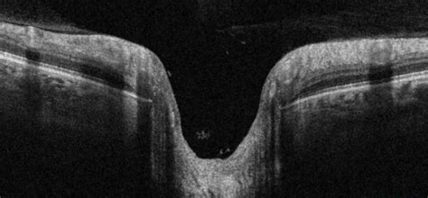 Oct In Glaucoma E Learning Viewpoint