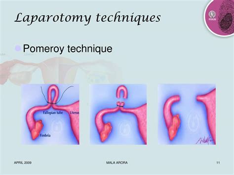 Ppt Female Sterilization Powerpoint Presentation Free Download Id