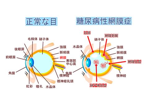 糖尿病の合併症 糖尿病網膜症 熊野路クリニック