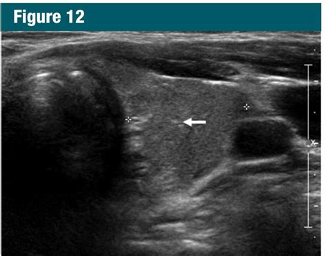 Sonogram Of The Left Thyroid Lobe In A 42 Year Old Man