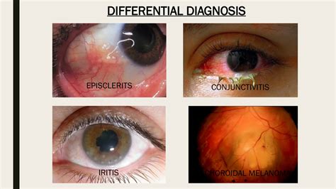 Episcleritis And Scleritis Causes Clinical Features Treatment Pptx