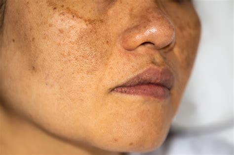 Skin Pigmentation Treatment In Ilford Shumailas