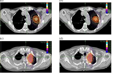 Comparison Between Ray Tracing Left And Monte Carlo Right Treatment Download Scientific