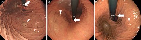 Polyps Upper Cardia Anorectal Polyps Treatment In Pune India Dr