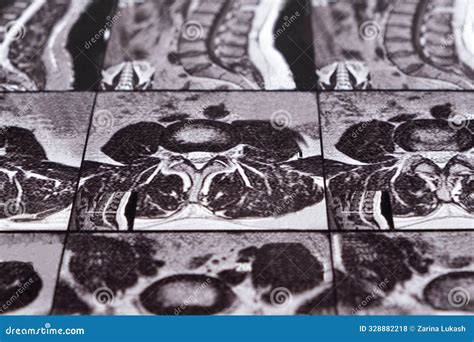 Mri Of A Patient With Intervertebral Disc Protrusion And
