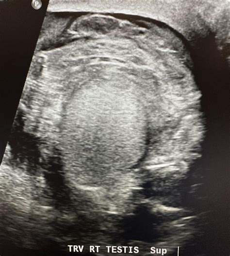 Ruptured Testicle 24 Hours Post Dirt Bike Accident Rradiology