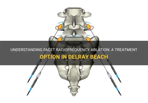 Understanding Facet Radiofrequency Ablation A Treatment Option In Delray Beach Medshun
