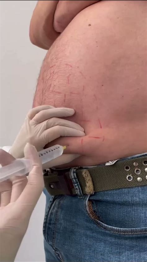 Needle Injection On Fat Mans Belly ThisVid Com