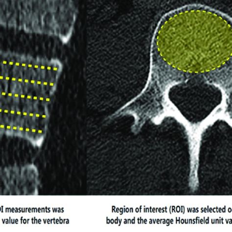 Hounsfield Unit Value Measurement Download Scientific Diagram