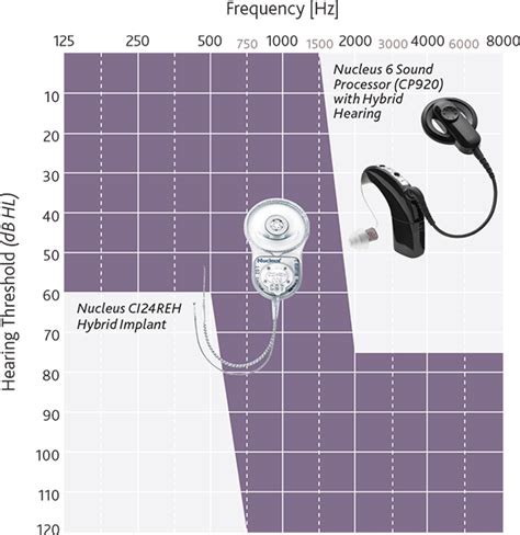 Hybrid Cochlear Implant Fills The Gap Between Partial And Profound Hearing Loss Ent Insights