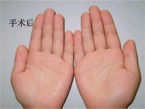 二手汗症手术治疗十大疑问详解 京东健康