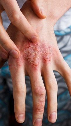 Apa Itu Penyakit Dermatitis Ketahui Gejala Penyebab Dan Cara Mengobatinya