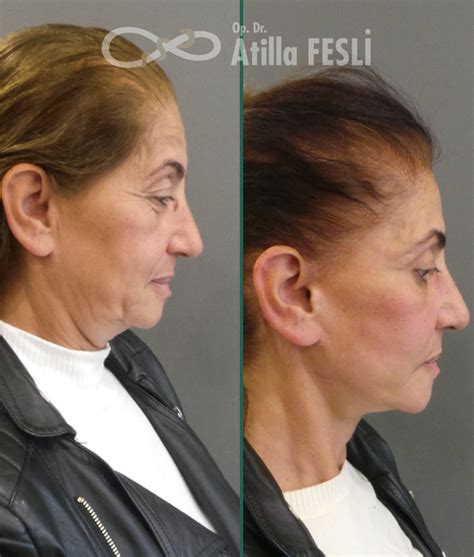 Facelift In Turkey Op Dr Atilla Fesli