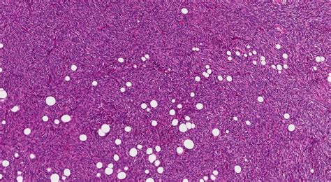 Dermatofibrosarcoma Protuberans Ottawa Atlas Of Pathology