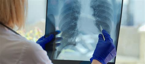 National Lung Cancer Screening Program To Launch July 2025 Australian Medical Association