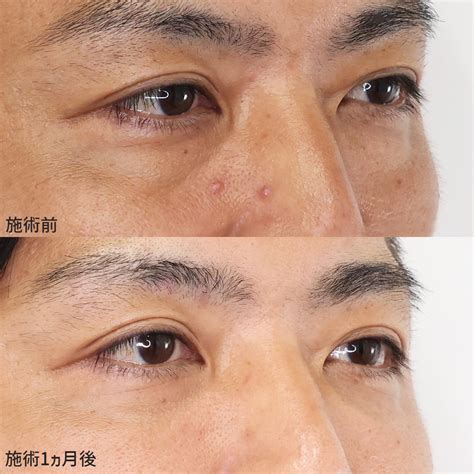 40代男性の悩みへの最適解 美容整形で【目の下のクマを消す方法】｜症例写真・ビフォーアフター｜美容整形･美容外科のtaクリニックグループ