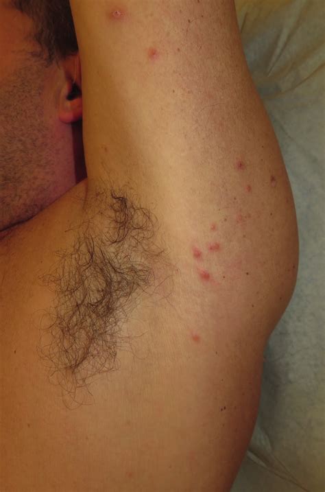 Prurigo Simplex Erythematous Papules And Papulo Vesicles On The Upper Download Scientific