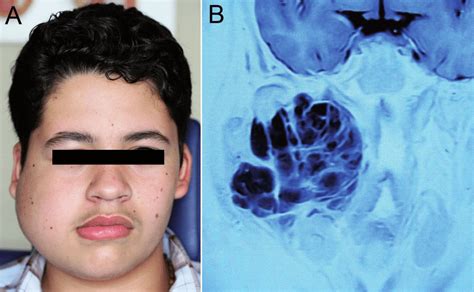 Clinical And Imaging Features Of Extraskeletal Myxoid Chondrosarcoma Download Scientific