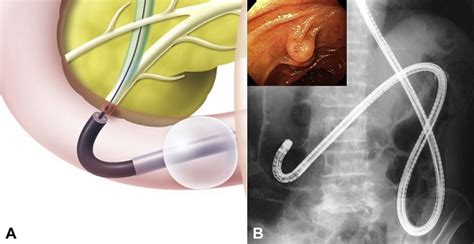 Editors Choice Balloon Enteroscopy Assisted Ercp