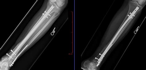 Minimally Invasive Tibia And Fibula Fracture Surgery San Jose Ankle