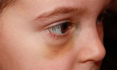 15 Home Remedies To Get Rid Of Black Eye Infographic Home Remedies