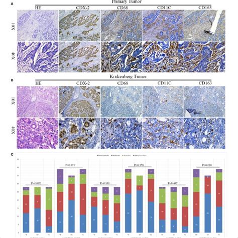 Grade Scoring Of Cd68 Tams In Tumor Stroma Of Primary Tumors A