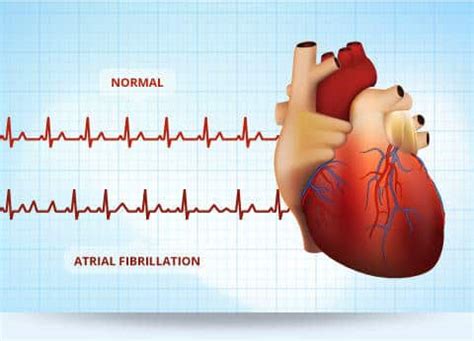 Atrial Fibrillation And High Blood Pressure Readings