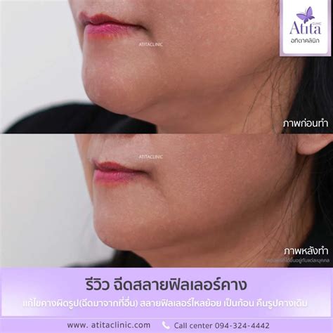 ฉีดสลายฟิลเลอร์ วิธีแก้ไขฉีดฟิลเลอร์บวมเป็นก้อน ฉีดมาแล้วไม่สวย