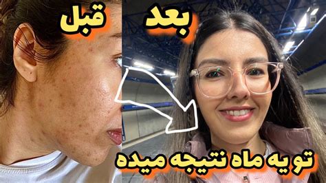 این روتین پوستمو نجات دادرفع جوش و جای جوش Youtube
