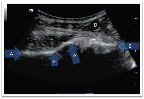 Sonographic Evaluation Of A Recurrent Shoulder Dislocation With Pocus