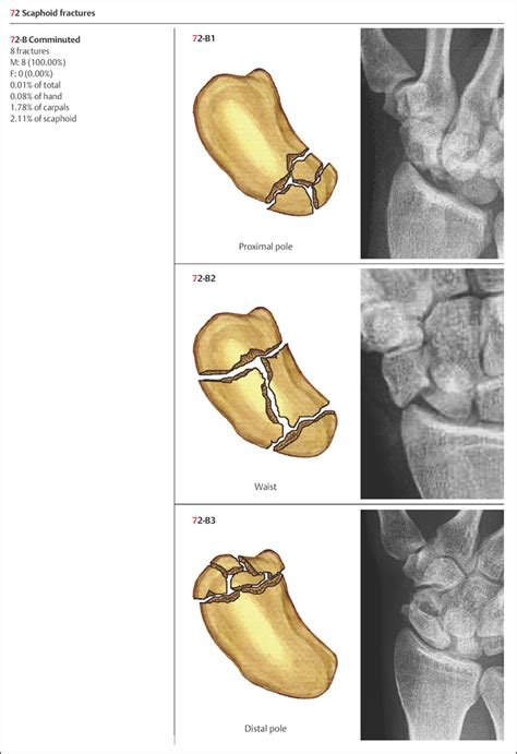 Hand Fractures Musculoskeletal Key
