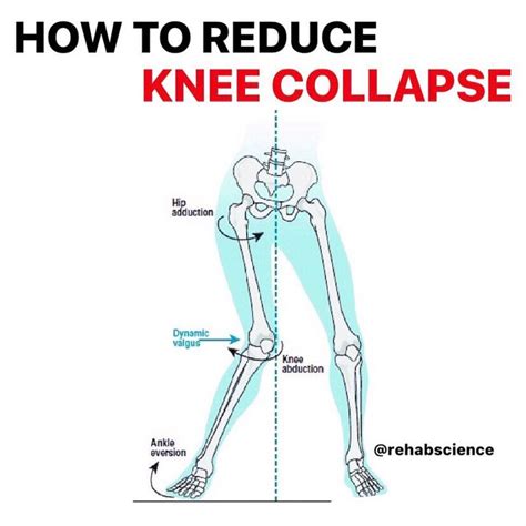 Dr Tom Walters Dpt On Instagram “💥𝐊𝐧𝐞𝐞 𝐕𝐚𝐥𝐠𝐮𝐬💥 ——— 🧠medial Valgus