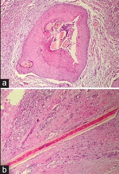 Interdigital Pilonidal Sinus Report Of Two Cases Pmc
