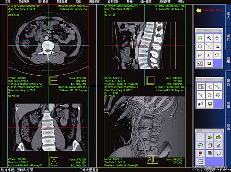 带三维重建和还原功能的医学影像管理系统（pacs）源码 三维重建曲面提取 Csdn博客