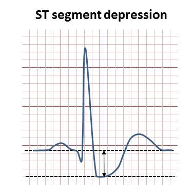 St Depression Wikipedia