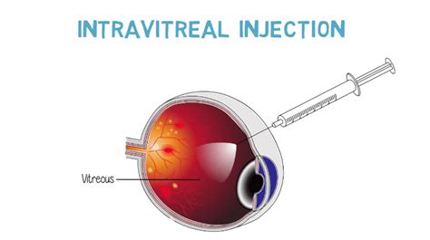Retinal Treatments